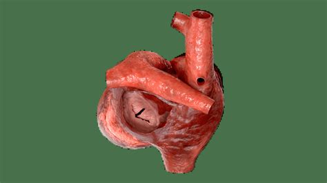 3d Model Of Atrioventricular Canal Defect Voka