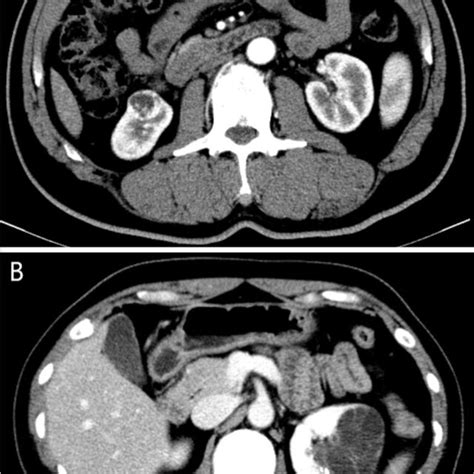 The Representative Imaging Of CRM With NonCR A And CR B Download Scientific Diagram