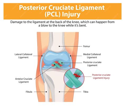 Free Vector Posterior Cruciate Ligament Pcl Injury
