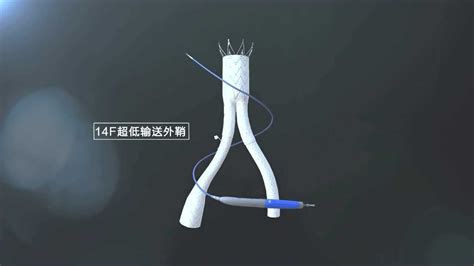 Minos腹主动脉覆膜支架及输送系统 高清1080p在线观看平台 腾讯视频