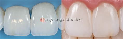 Anterior And Posterior Composite Dental Course Esthetic Professionals