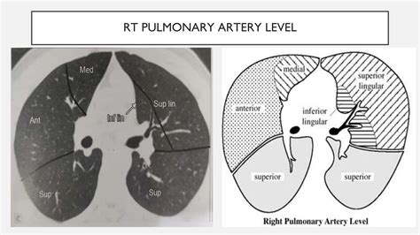 Bronchopulmonary Segments Radiology And Imaging Pptx