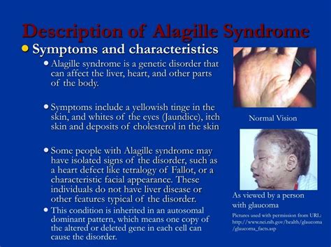 Ppt Alagille Syndrome And Genetic Implications Powerpoint