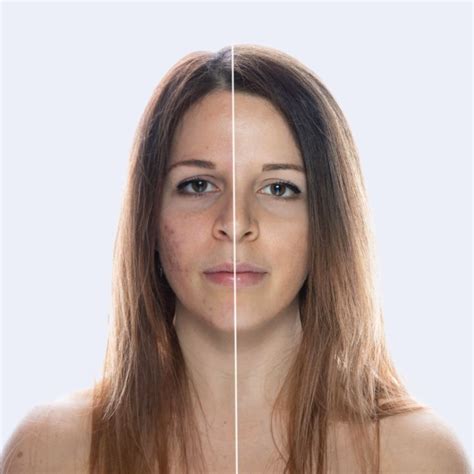 Acne Solution Merle Norman Metuchen