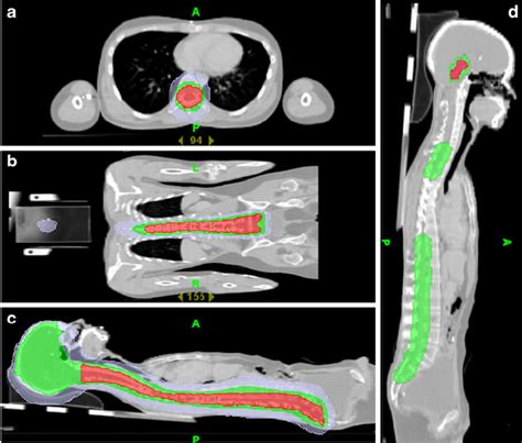 Dose Wash Of Helical Tomotherapy Based Reirradiation Of The