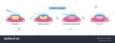 Cataract Surgery Process Anesthesia Incision Cataract Stock Vector Royalty Free 2493266469