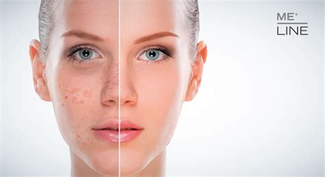 Hyperpigmentation