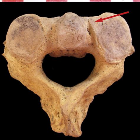 C2 Vertebra With Shortened Or Hypoplastic Dens And Separate Ossicle