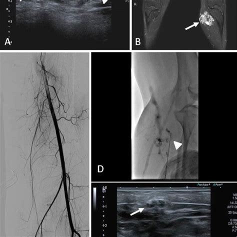 Percutaneous Sclero Embolization Of A Simple Low Flow Vascular Download Scientific Diagram