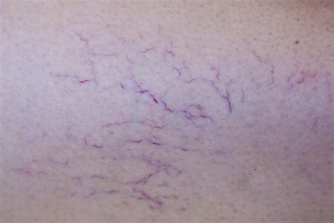 Skin Concerns Veins Dthomas Clinic