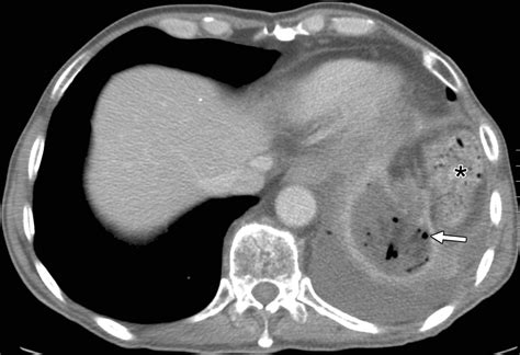 Complex Abdominal And Pelvic Abscesses Efficacy Of Adjunctive Tissue