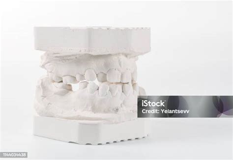 Gigi Casting Gipsum Model Rahang Manusia Gigi Bengkok Dan Gigitan Distal Tembakan Dilakukan