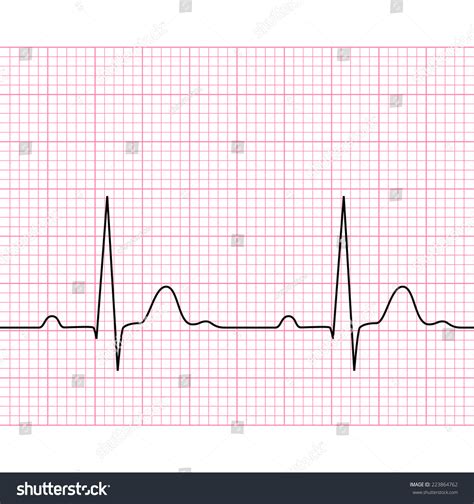 Electrocardiogram Graph Ekg Heart