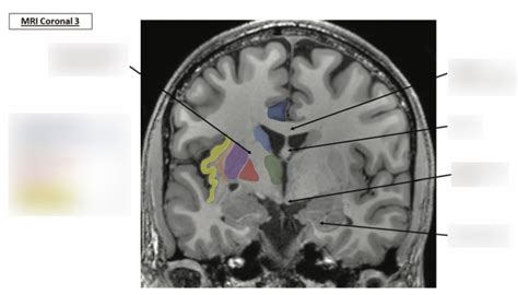 Neuro Lab 8 Mri Coronal 3 Diagram Quizlet