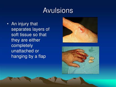 Ppt Soft Tissue Injuries Chapter 19 Powerpoint Presentation Free
