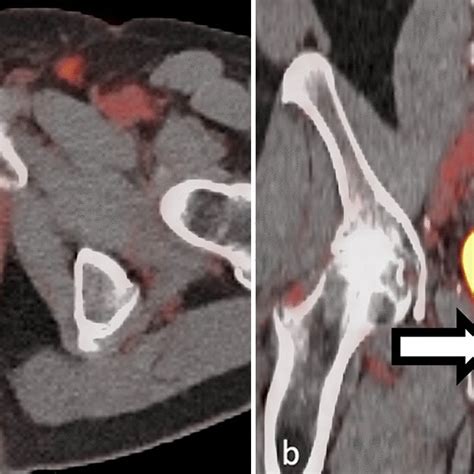 Ac Example Of Single Psma Lymph Node Disease In A 54 Year Old With