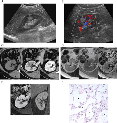 Mri Features Of A Solid Mass Like Renal Lymphangioma Case Report