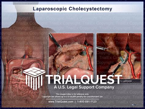 First Steps Of A Laparoscopic Cholecystectomy Trialquest Inc