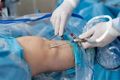 Vascular Surgery Senthil Speciality Hospital