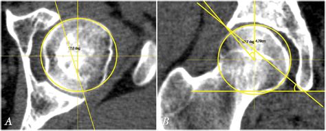 Acetabular Anteversion Acetabular Inclination And The Ce Angle Download Scientific Diagram