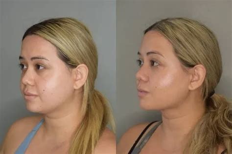 Chin Lipo Swelling Chin Lipo Faja Chin Liposuction Massage