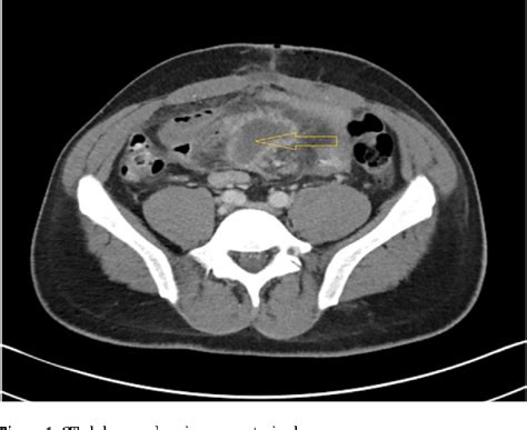 Mesenteric Abscess Semantic Scholar