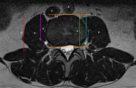 Representative Illustration On An Axial Mri Section Of Various