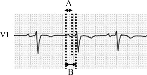 Schematic Representation Of P‐wave Duration In Lead V1 A Is The P‐wave