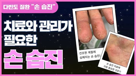 치료가 필요한 손 습진 관리법 가렵고찢어지고뜯어지고갈라지는 고통😭😭 절대 하지 말아야 할 것 손습진 관리 이렇게만 따라하세요 ⭕ 손습진 손습진치료