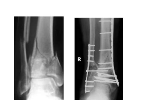 Pilon Fracture Pptx