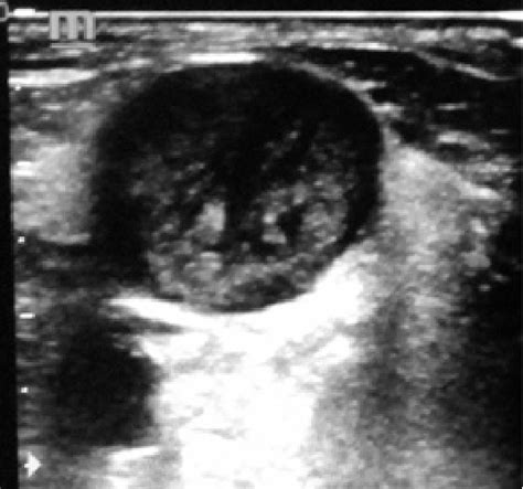 Figure 1 From Common Peroneal Nerve Schwannoma A Rare Cause Of