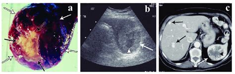 Angiosarcoma Of The Spleen Source Wmthomson Angiosarcoma Of The