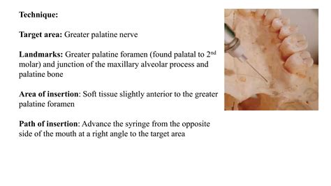 Maxillary Nerve Block Pptx Maxillary Nerve Block Pptx