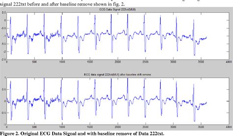 Figure 2 From Suppression Of Noise In Ecg Signal Using Low Pass Iir