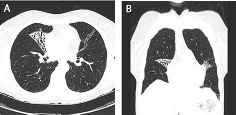 Nodularbronchiectatic Form Of Nontuberculous Mycobacterial Lung Download Scientific Diagram