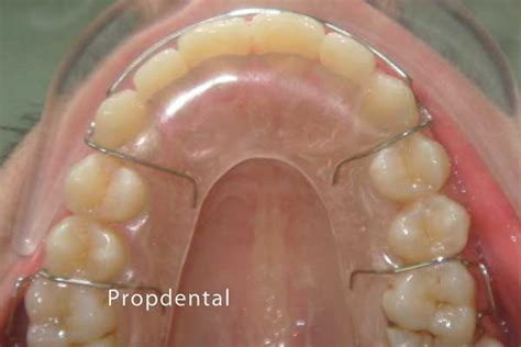 Retenedores De Ortodoncia Ortodoncia Retenedores Dentales