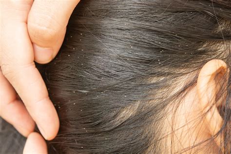 Head Lice Pictures What Does A Lice Bite Look Like