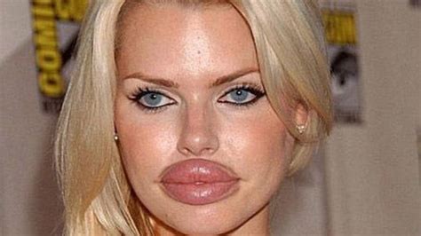 A Brief History Of Lip Augmentation Dazed