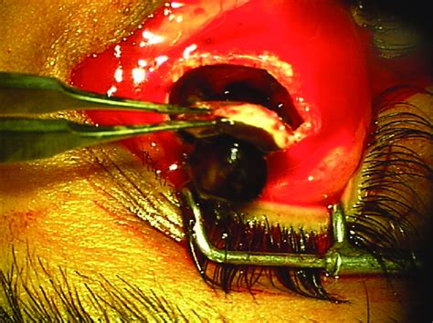 Evisceration Procedure Download Scientific Diagram