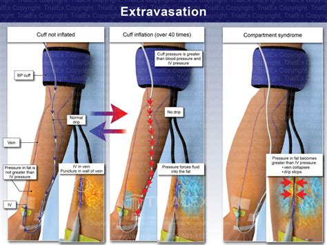 Extravasation Trialquest Inc