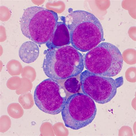 Hydroxyurea Induced Ulcers On The Leg Of A 73 Year Old Man With Chronic Download Scientific