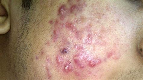 Why Do I Have Purple Spots On My Face After Acne