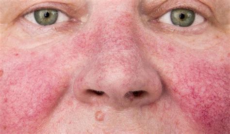 Lupus Eritematoso Sistemico Oral