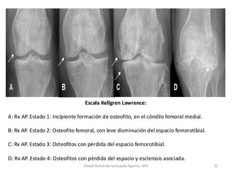 Escala Kellgren Lawrence D Clasificación Radiológica De Artrosis