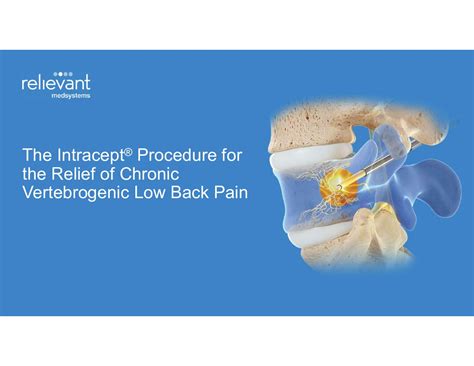 Intracept Procedure Pain Specialists Of Greater Chicago
