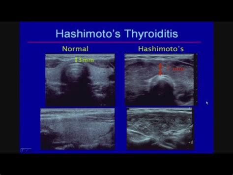 Normal Thyroid