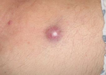 Merkel Cell Carcinoma Warning Signs And Images