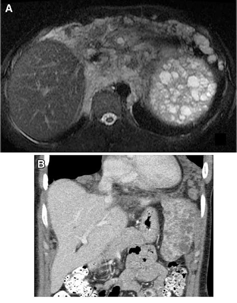 Diffuse Lymphangiomatosis A Axial T2 Weighted MR Image And B Coronal Download Scientific