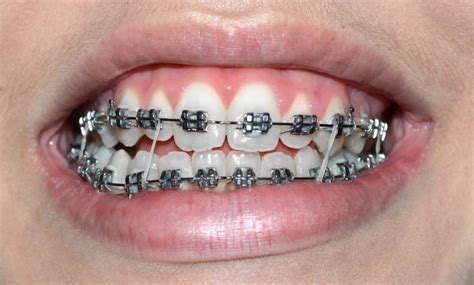 What Do Rubber Bands On Braces Actually Do General Dentistry Sedation Dentistry Located In