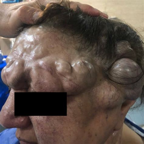 Marrow A 41 Year Old Female Presents With A Tortuous Swelling Over